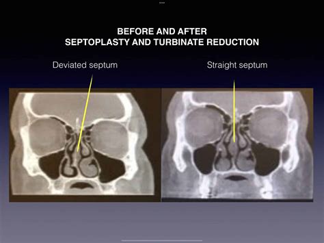 Before After Sinus Cases Sinus And Snoring Specialists