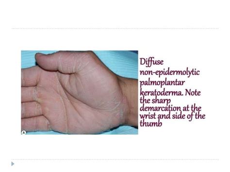 Genodermatoses Pptx Skin And Dermatology Diseases And Conditions