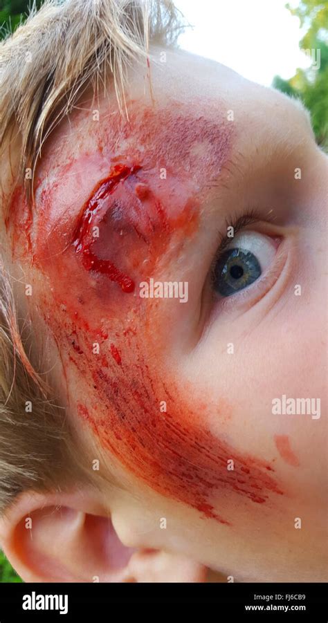 Major Laceration