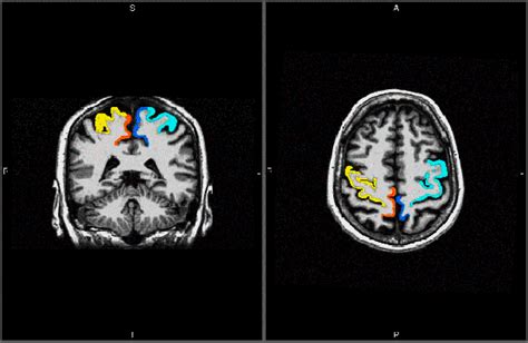 Tract Based Spatial Statistics Tbss Results Statistical Maps P