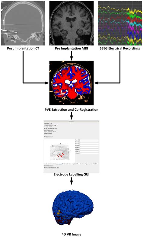 Overview Of The Software Pipeline Outlining Input Of Ct Mri And Seeg Download Scientific