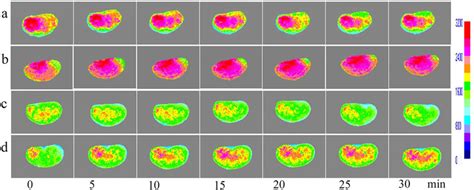 visualization of laser speckle perfusion imaging lspi for the liver