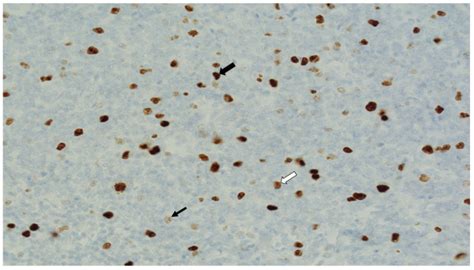 Icd 10 Code For Benign Prostatic Hyperplasia Bph