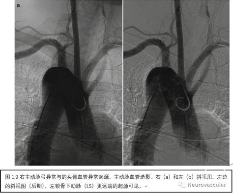 脑血管造影读片基础图谱——颈内动脉、颈外动脉、主动脉弓 脑医汇