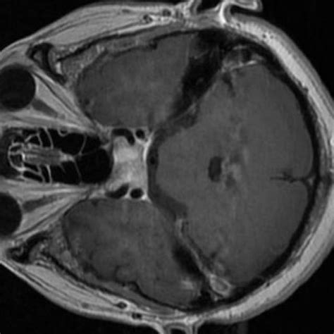 Brain Tumor Object Detection Model V1 2024 07 04 416pm By Academia