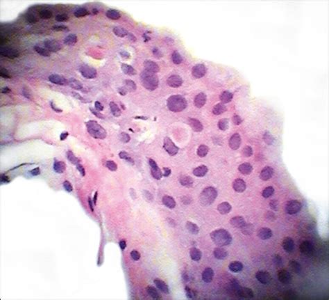 Ocular Graft Versus Host Disease Clinical Tree