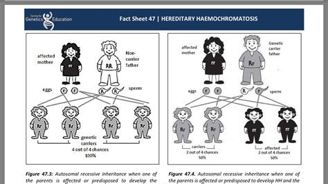 Hfe H63d Gene Mutation The Forgotten Class Of Hemochromatosis
