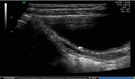 Figure 3 From Ultrasound In Ambiguous Genitalia Semantic Scholar Figure 3 From Ultrasound In Ambiguous Genitalia Semantic Scholar