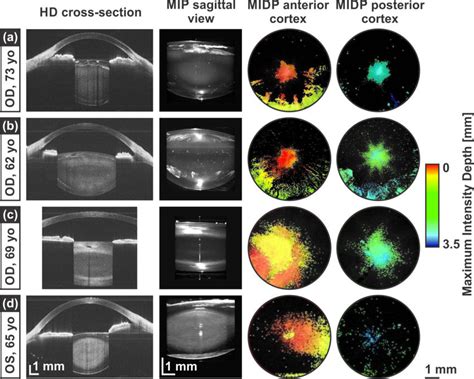 SS OCT Imaging Of Cortical And Nuclear Cataract In The Lens A Download Scientific Diagram