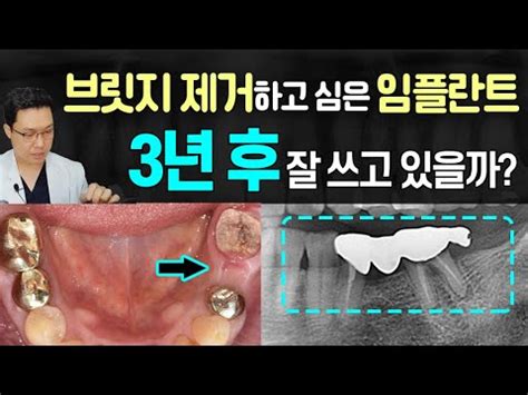 왼쪽 아래 어금니가 씹지도 못할 정도로 아파요ㅜㅜ 년 전에 했던 브릿지 제거하고 차원 모의수술로 결과 좋은 임플란트로 개선