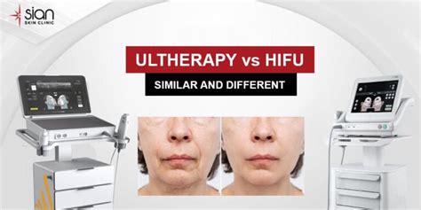 Ultherapy Vs Hifu Which Ultrasound Technology Is Better Sian Skin Clinic