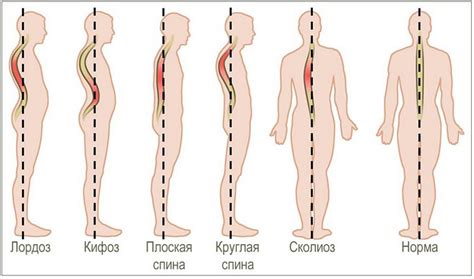 Сколиоз 2 степени: можно ли вылечить, S образный, C образный