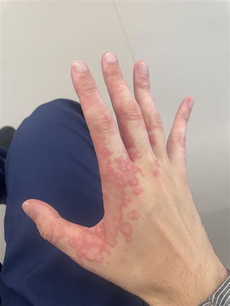 Cool Rash I Got Several Days After Being Out In The Woods R