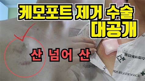 케모포트 제거 과정 샅샅이 대공개 제거 후 Qanda 비용공개i 암환자브이로그 I 유방암브이로그 I 환자브이로그 I I 표적