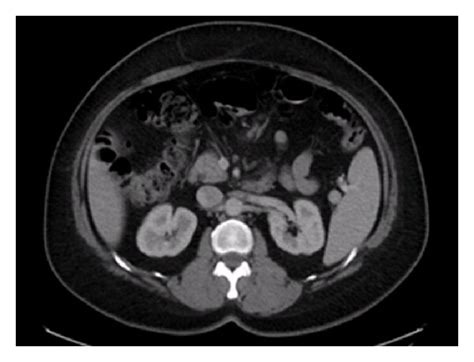 Heterogeneous Liver With Multiple Low Attenuating Foci And A Soft Download Scientific Diagram