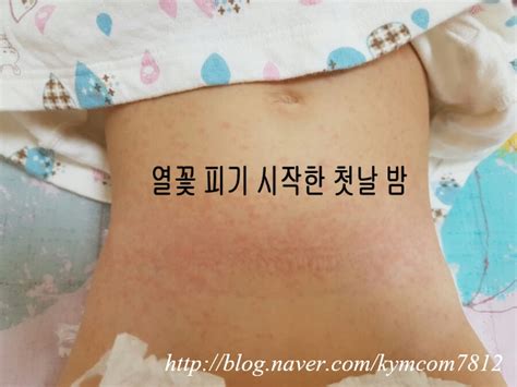열꽃증상 열이난후 붉은 두드러기 네이버 블로그