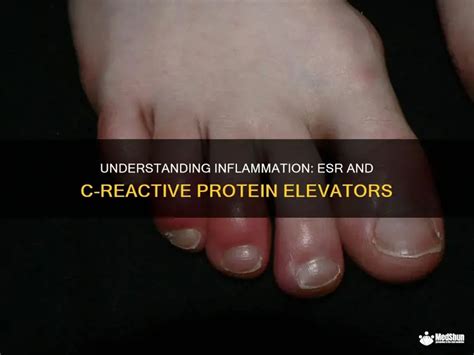 Understanding Inflammation Esr And C Reactive Protein Elevators Medshun