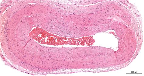 Histological Interpretation Of Temporal Artery Biopsies Diagnostic