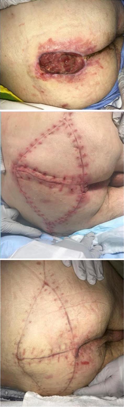 Bilateral V To Y Fasciocutaneous Flap Pre Surgical Procedure Above