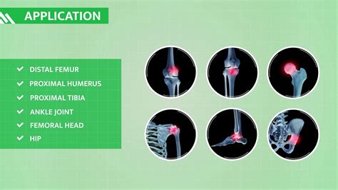 Mri Bone Marrow Edema Distal Femur