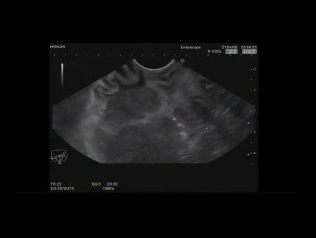 GIST MEDtube Net