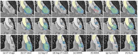 Results Of Different Methods For Ct Image Segmentations Each Row