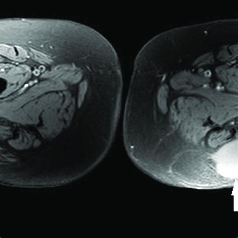 Axial T2 Weighted Mri Sequence Depicting A Homogenous High Signal