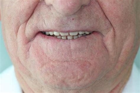 Composite Build Ups Specialist Oral Health Care Advice Prosthodontics Periodontics