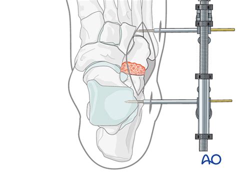 Primary Fusion Of Unreconstructable Calcaneocuboid Joint