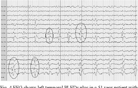 Figure 4 From Can Eeg Test Helps In Identifying Brain Tumor Semantic Scholar