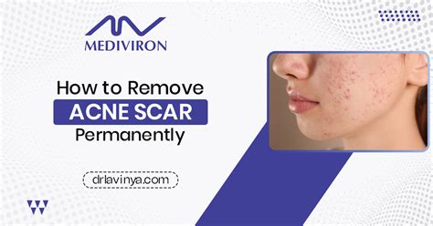 How To Remove Acne Scars Permanently Skin Clinic