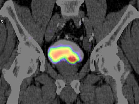 Enhanced Diagnostic Accuracy Of Tc Psma Spect Ct Vs Mpmri In Prostate Cancer Staging And