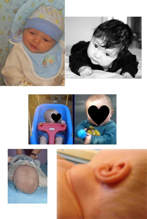 Torticollis Diagram Torticollis Spasmodic Infodystonia