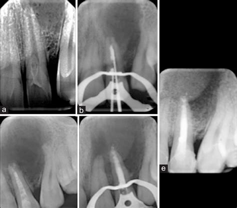 Preoperative Radiographs Of 22 With Dens In Dente Type Ii Showing