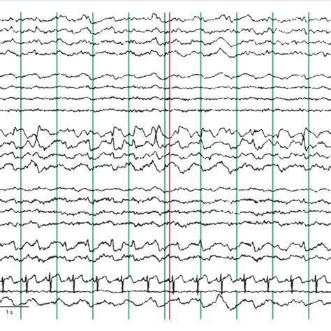 Direct Visualization Of The Left Frontal Convexity Intraoperatively Download Scientific Diagram