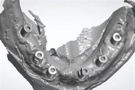 Digital Dental Implants Digital Scan Bodies