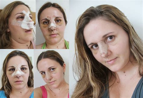 Recuperação - Rinoplastia | Olá pessoal!! Ai estou eu de nar… | Flickr