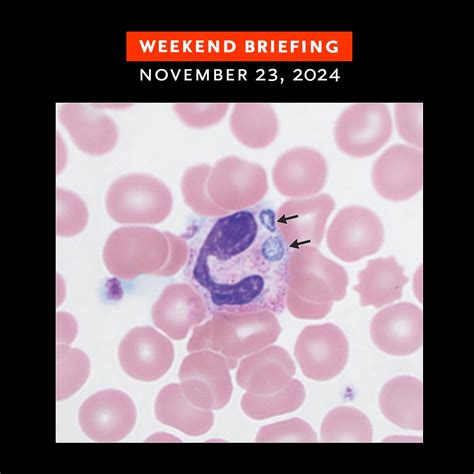 Segmented Neutrophils Nejm On X 🧵 Weekend Briefing For November
