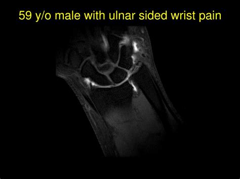 PPT 59 Y O Male With Ulnar Sided Wrist Pain PowerPoint Presentation Free Download ID 5528815