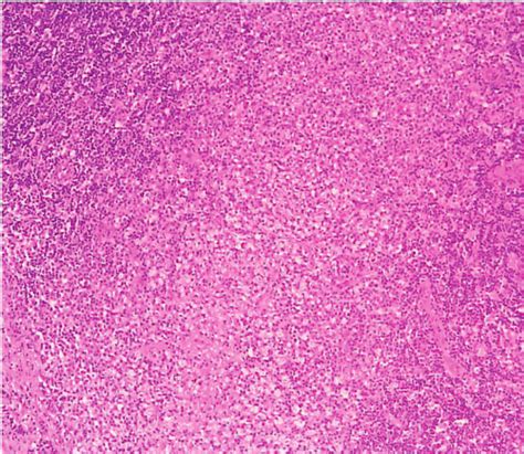 Area Of Focal Necrosis Admixed With Karyorrhectic Debris Download