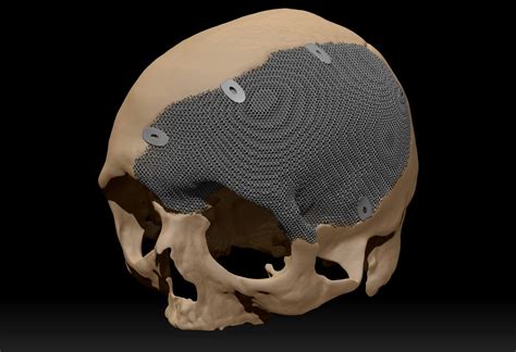 Cranial Plating