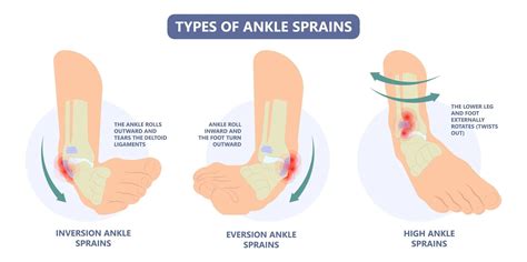 High Ankle Sprain Swelling