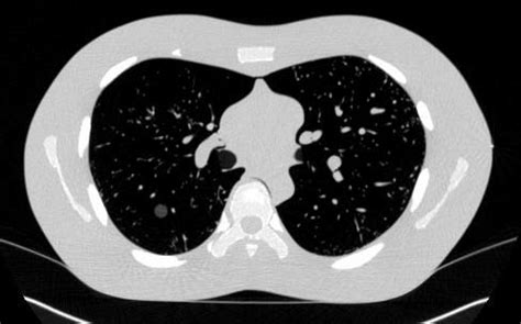 Example Of A Lung Phantom CT Scan Acquired With Slice Thickness Download Scientific