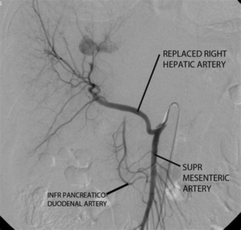 Mesenteric Doppler Flashcards Quizlet