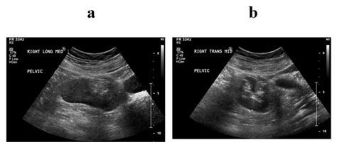 Surgical Management Of Pelvic Organ Prolapse In A Woman With Right