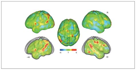 Grey Matter Correlates Of Autistic Traits In Women With Anorexia