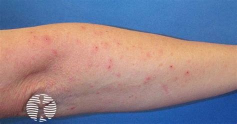 Prurigo Of Pregnancy Image