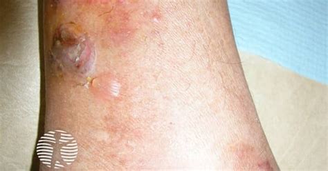 Diabetic Blisters On Legs
