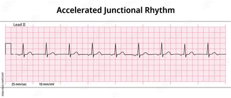 Vetor De Ecg Accelerated Junctional Rhythm Escape Rhythm 8 Second