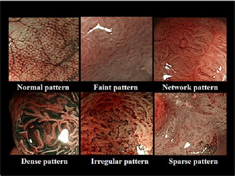 Showa Classification Download Scientific Diagram